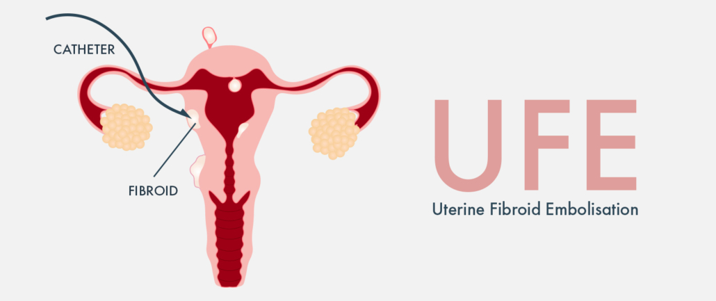 UFE – MIC Radiology Group