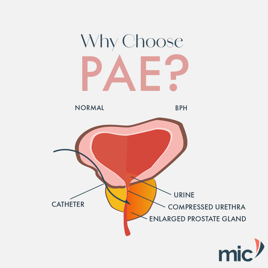 Why Choose PAE? – MIC Radiology Group