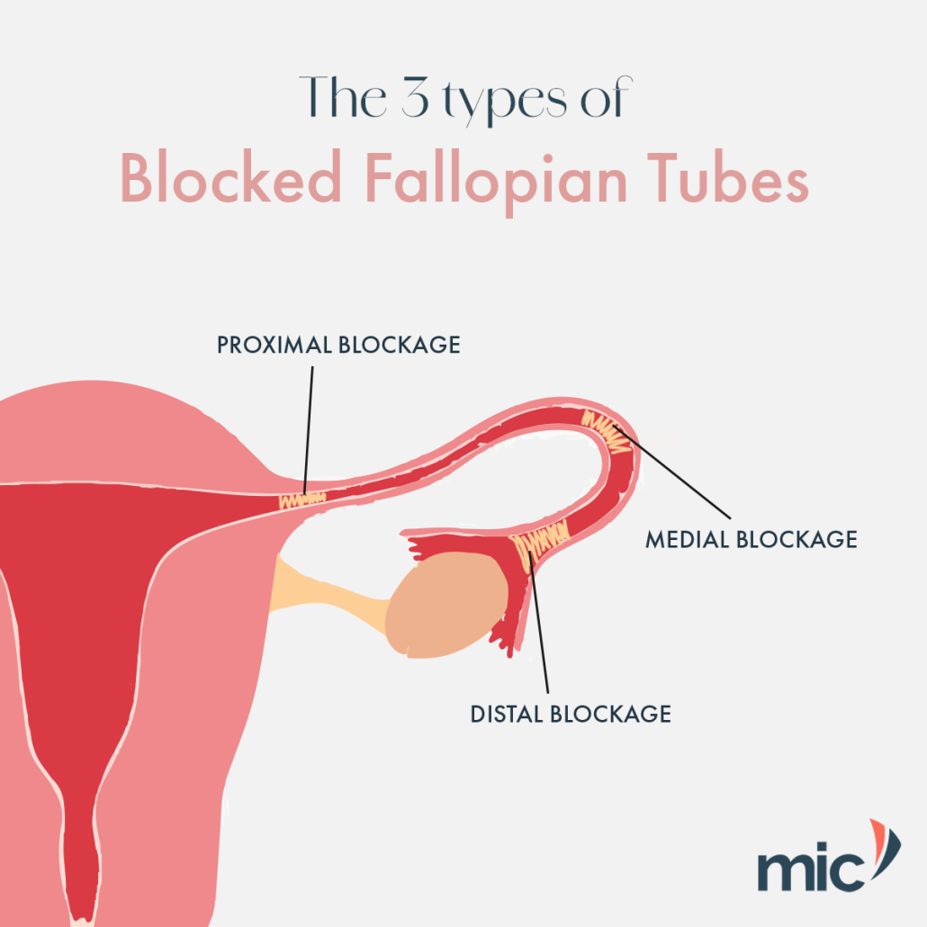 The 3 types of blocked fallopian tubes – MIC Radiology Group
