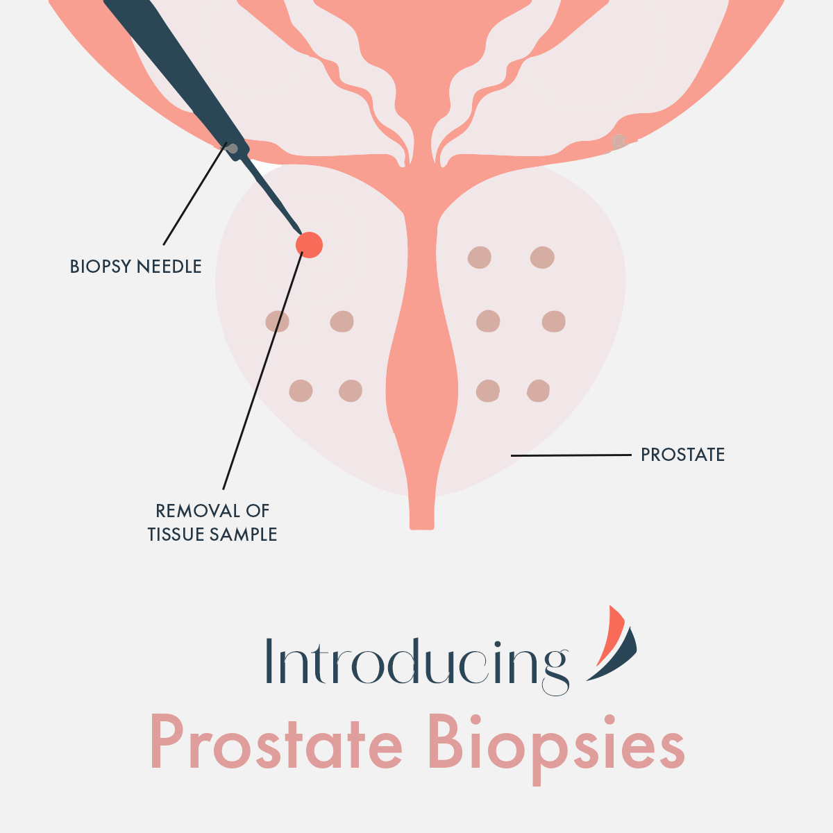 Introducing Prostate Biopsies! – MIC Radiology Group