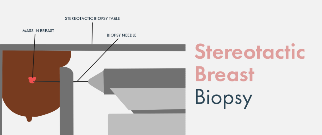 Stereotactic breast biopsy – MIC Radiology Group